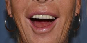 Lower Lip Droop Following Injection of Botox to the Mentalis Muscle