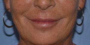 Lower Lip Droop Following Injection of Botox to the Mentalis Muscle