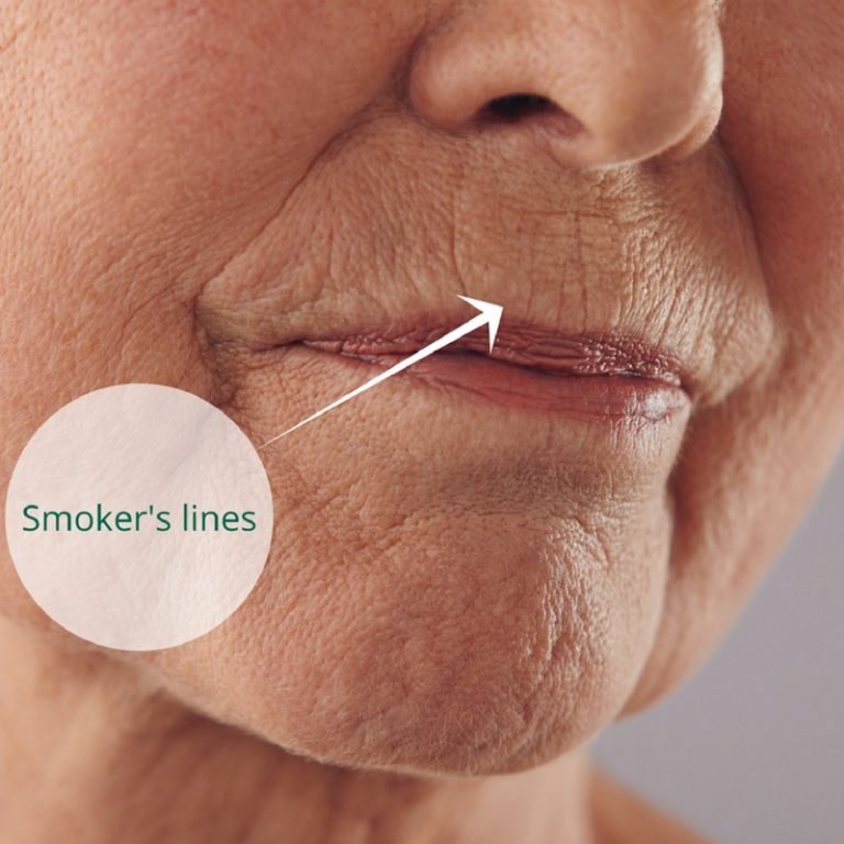 Model FAQ: "How do I soften wrinkles around the mouth?" - Cosmetic Courses