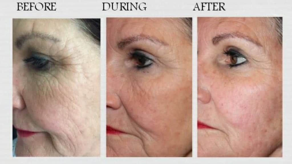 What is Rederm? - Cosmetic Courses